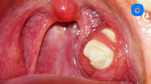 Tonsilolitos (Bolitas Blancas): Causas, Síntomas y Tratamiento