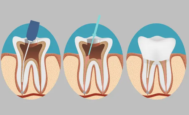 ¿Qué es y cómo se realiza una Pulpotomía dental? - Cleardent