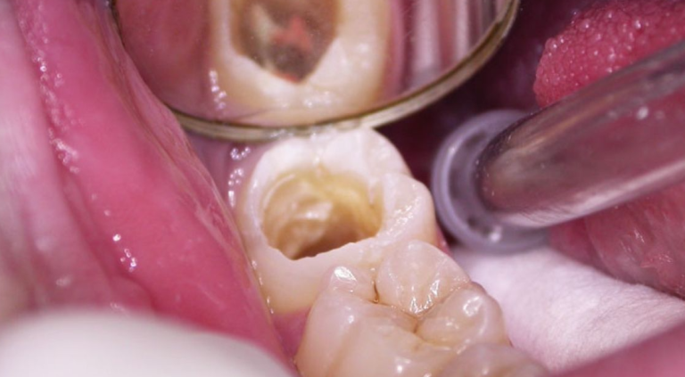 Pulpectomía dental: qué es, cuándo se hace y cómo es el procedimiento ...