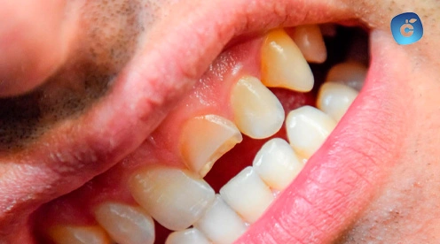 ¿Se puede arreglar un diente roto sin ir al dentista? Riesgos y ...