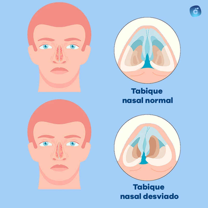 Sinusitis: Causas, Síntomas y Tratamiento - Cleardent | Clínicas Dentales Sinusitis: Causas, Síntomas y Tratamiento - Cleardent | Clínicas Dentales